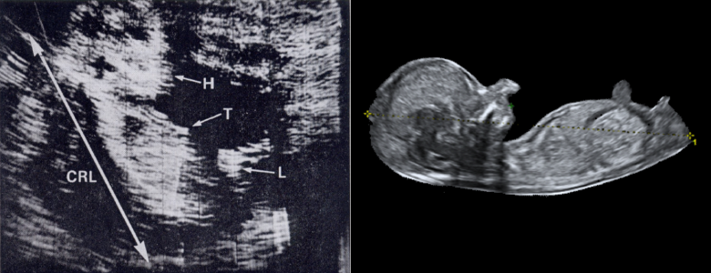 La nouvelle biométrie fœtale 3.0 : intérêt d’Intergrowth 21 | SFR e ...