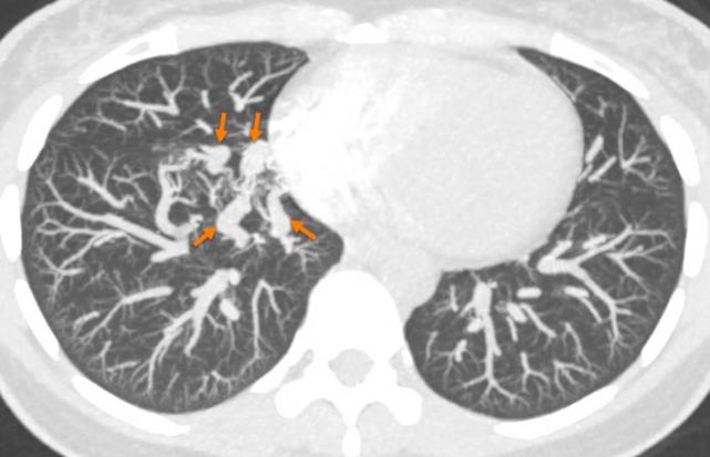 Apport du scanner à large couverture en pathologie thoracique | SFR e ...