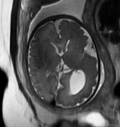 IRM fœtale : le temps de la maturité | SFR e-Bulletin