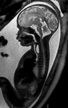 IRM fœtale : le temps de la maturité | SFR e-Bulletin