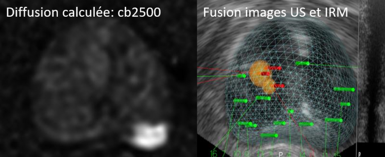 Diagnostic du cancer de prostate : parcours de soin organisé | SFR e ...
