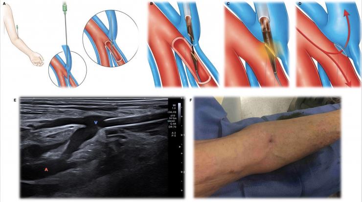 Création de fistule artérioveineuse d’hémodialyse par voie percutanée ...