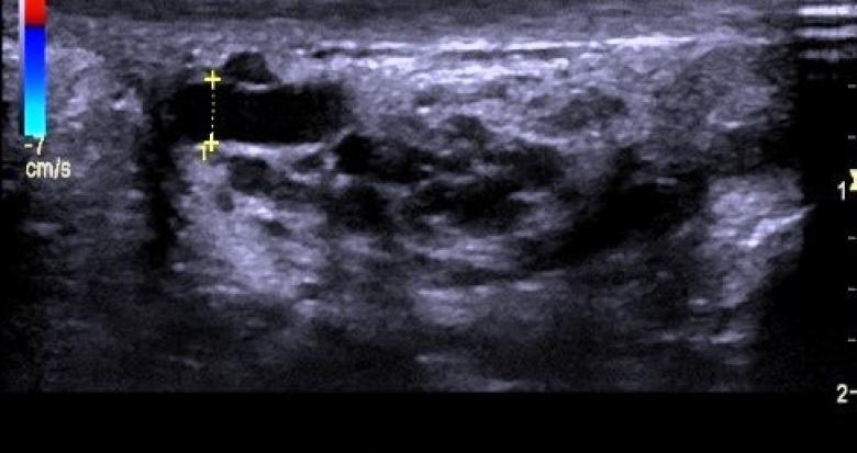 Prise en charge radiologique de la varicocèle : du diagnostic au ...