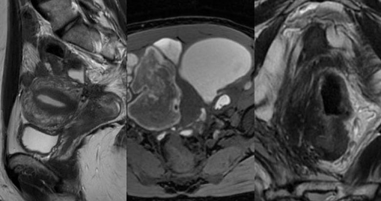 Endométriose pelvienne : comment je fais et comment j’interprète mon ...