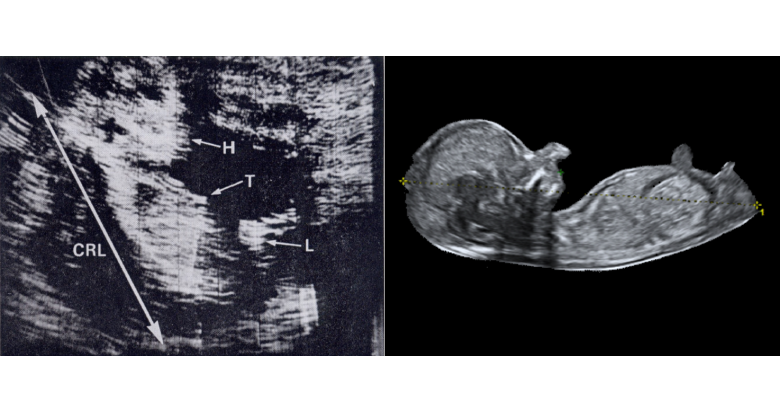 La nouvelle biométrie fœtale 3.0 : intérêt d’Intergrowth 21 | SFR e ...