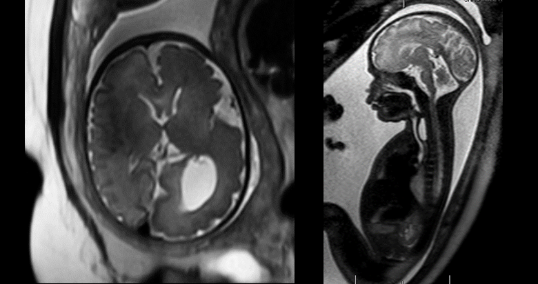 IRM fœtale : le temps de la maturité | SFR e-Bulletin