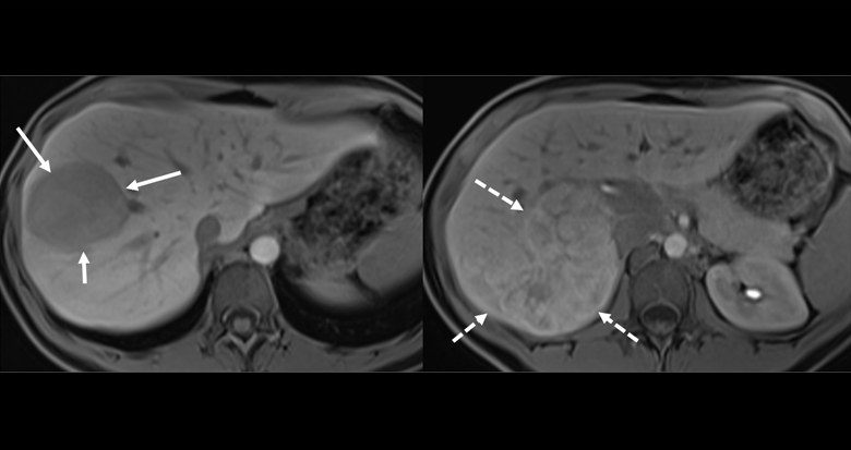 Produits de contraste hépatobiliaires et imagerie du foie : actualités ...