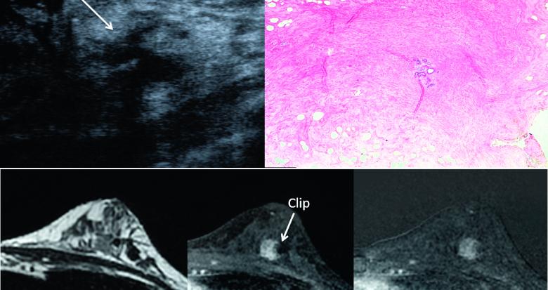 L’IRM mammaire : votre meilleur alliée ? | SFR e-Bulletin