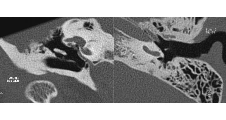 Leave me alone lesions en imagerie ORL | SFR e-Bulletin