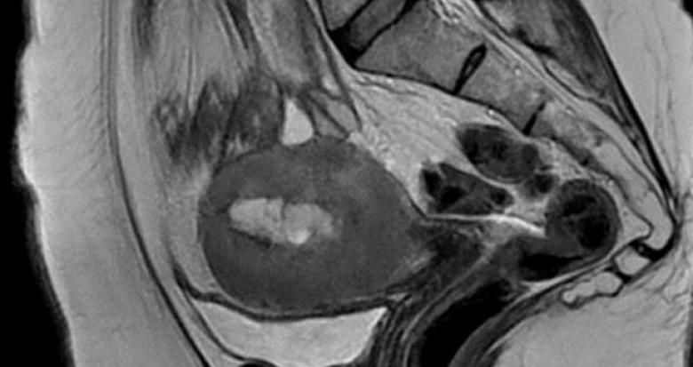 Tout savoir (ou presque) sur le cancer de l’endomètre en moins de 2 ...