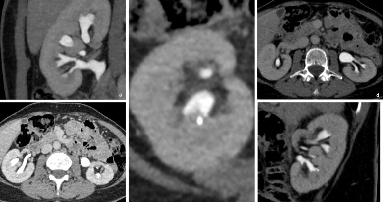 Des nouveautés dans les protocoles d’imagerie des voies excrétrices et ...