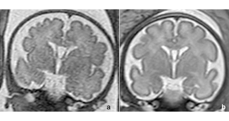 L’IRM fœtale à 3 Tesla | SFR e-Bulletin