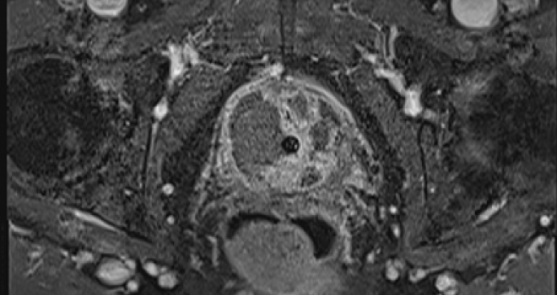 L’embolisation : vers un traitement de première intention des ...