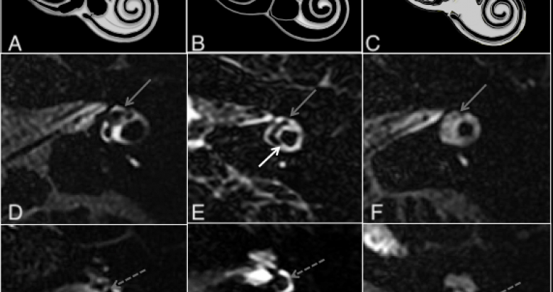 Vers une généralisation de l’acquisition tardive pour l’exploration des ...