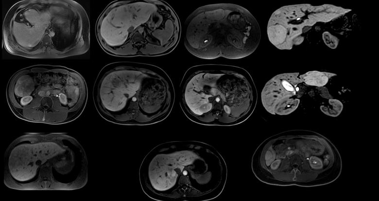 Atouts de la radioembolisation à l’Yttrium-90 par SIR-Spheres dans le ...