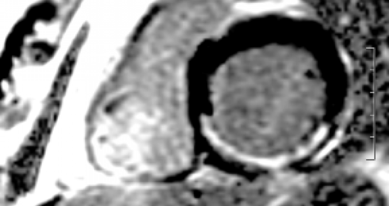 IRM cardiaque : La nouvelle imagerie de référence ? | SFR e-Bulletin